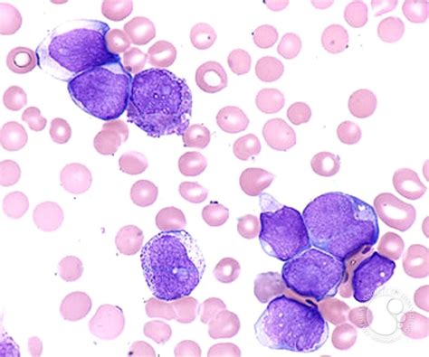 Blast Crisis Of Cml 2