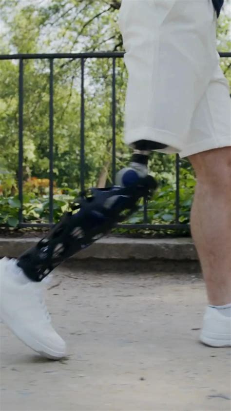 Prosthetic Types Artofit