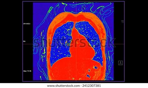 Ct Scan Chest Coronal View Color Stock Illustration 2412307381