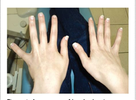 Figure 1 From Dental Treatment Of A Patient With Opitz G Bbb Syndrome