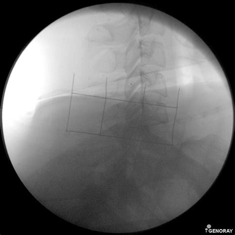 씨암블럭 전용 인디케이터 닥터차폐 C Arm 방사선 차폐쉴드