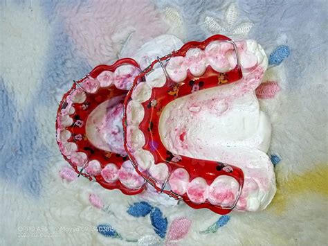 รีเทนเนอร์ไร้เหงือกแบบท รีเทนเนอร์ไร้เหงือกแบบท่อสี 30บ