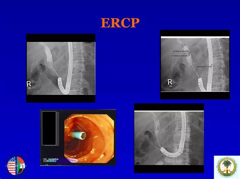 Biliary Pancreatitis Ppt