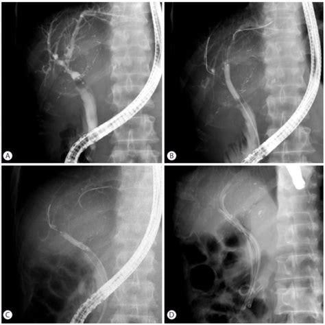 Cholangiogram Of An Anastomotic Stricture As In A 50 Year Old Man