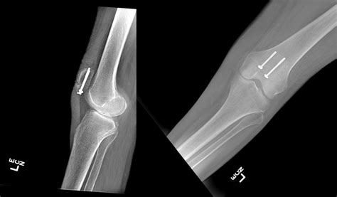 Patella Fractures Treatment And Management Point Of Care