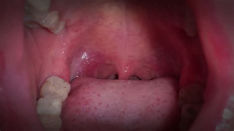 Asmr Nana困薯 Restudio 舌頭展示 口腔检查 Eporner