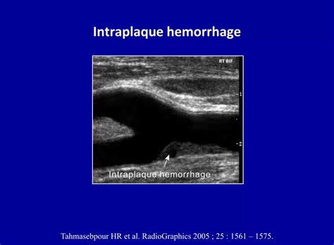 Doppler Ultrasound Of Carotid Arteries Pptx