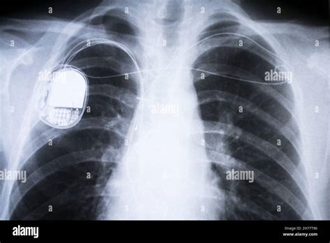 X Ray Imagefrom The Human Chest And Pacemaker Stock Photo Alamy