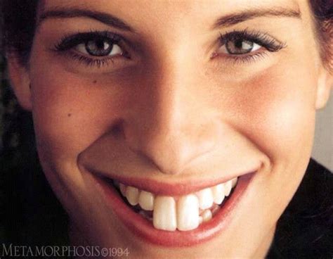 People With Rabbit Teeth