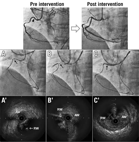 Outcomes Of Retrograde Approach For Chronic Total Occlusions By
