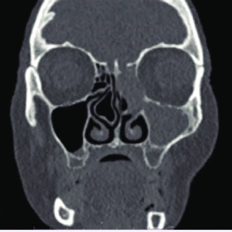 Aria Classification Of Allergic Rhinitis 1 Download Table