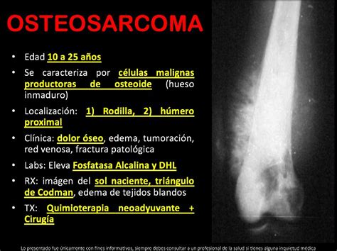 Triangulo De Codman