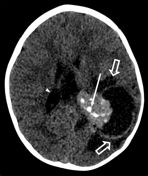Choroid Plexus Carcinoma In A 2 Year Old Girl Nonenhanced Ct Axial