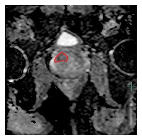 Multiparametric Mri Evaluation And Mri Trus Fusion Biopsy In Patient Download Scientific