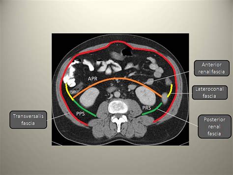 Retroperitoneal Anatomy Ct