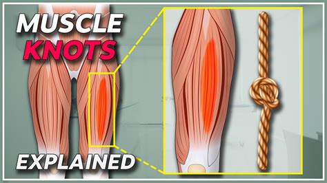What Is A Muscle Knot Muscle Knots And Trigger Points Explained Youtube