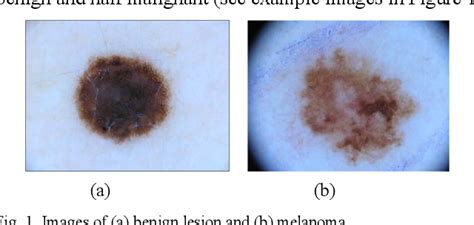 Figure 1 From Automatic Detection Of Melanoma With Yolo Deep Convolutional Neural Networks