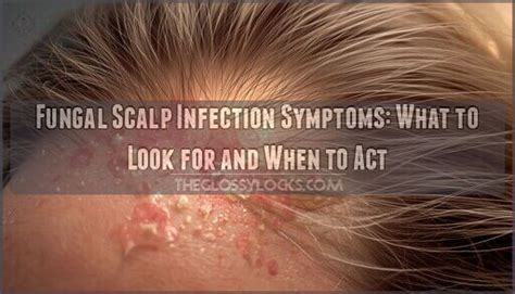 Fungal Scalp Infection Symptoms What To Look For And When To Act