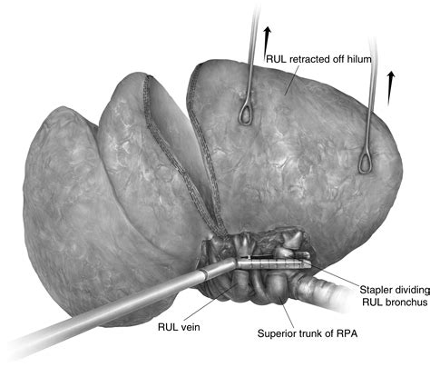 Video Assisted Thoracic Surgery Lobectomy Operative Techniques In