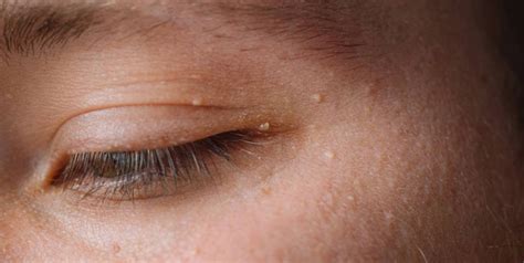 Confused Between Moles Skin Tags Warts Know The Difference From Expert Onlymyhealth
