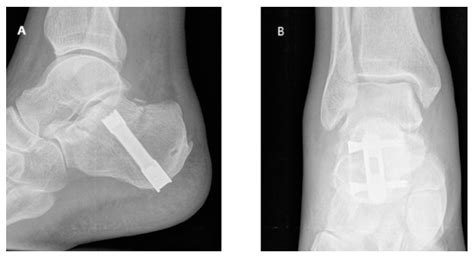 A Mid Term Result Of The Treatment Of Intra Articular Calcaneal
