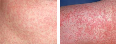 figure 3 from measles rash image detection using deep convolutional