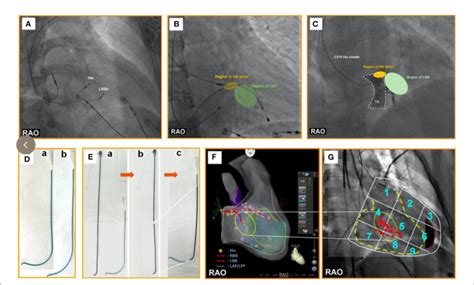 A One Pacing Lead Is Placed In The His Bundle Region An Anatomical Download Scientific Diagram