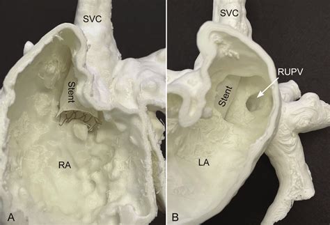 3d Printed Model Of Superior Sinus Venosus Defect Feasibility Of The