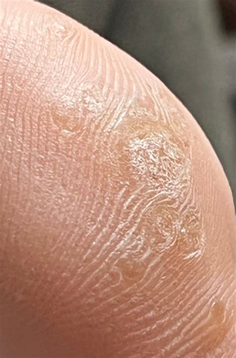발가락 아래 굳은살 지식in
