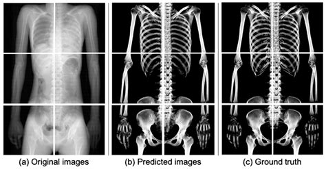 Gray Scale Extraction Of Bone Features From Chest Radiographs Based On Deep Learning Technique