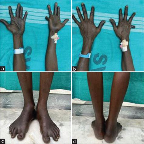 Reversible Hyperpigmentation Due To Vitamin B12 Deficiency Mimicking Addisons Pigmentation