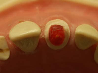 To 38 Finalizing The Preparing The Tooth And Shaping The CPC Pattern Resin Download