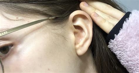 Closed Comedones Help Album On Imgur