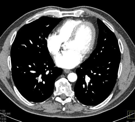 Incidental Pulmonary Embolism Pe In The Right Lower Lung Chest