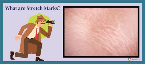 Stretch Marks Prevention And Treatments Skin Type Solutions