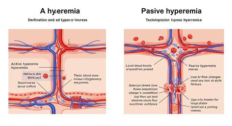 Hyperemia Definition Types And Clinical Importance