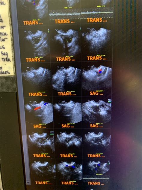 Can Anyone Read An Ultrasound Pcos Normal Abnormal Glow Community