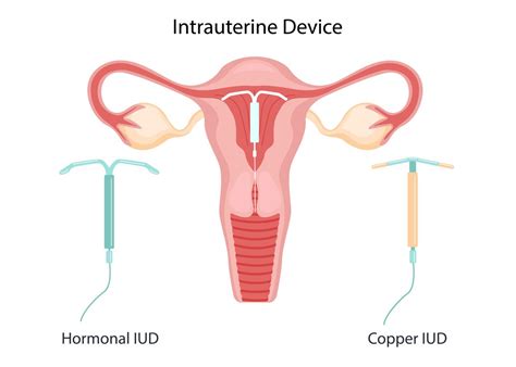 IUD Spiral: Efek Samping, Jenis, Pemasangan, Kelebihan, dan Kekurangan