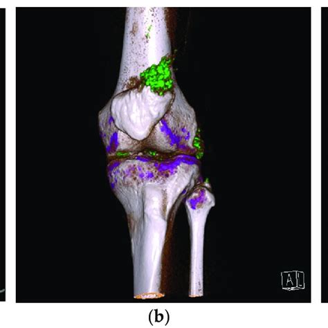 Receiver Operating Curves Of The Different Gout Diagnostic Tools Dect