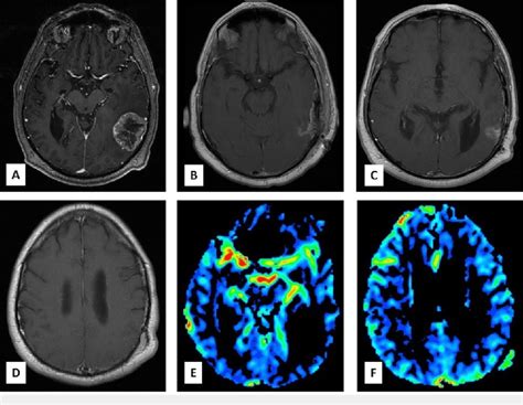 Scalp Metastasis Post Craniotomy And Radiosurgery A D Gadolinium