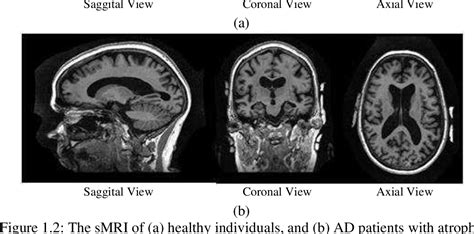 Table 2 2 From Structural Mri Based Classification Of Alzheimers Disease Semantic Scholar