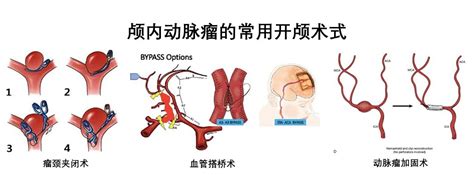 颅内动脉瘤，到底是介入好，还是手术好？ 脑医汇