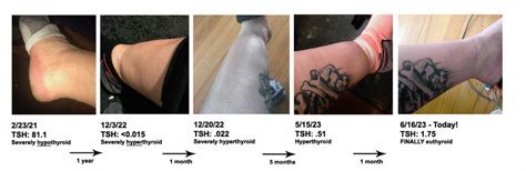 Thyroid Swelling Feet