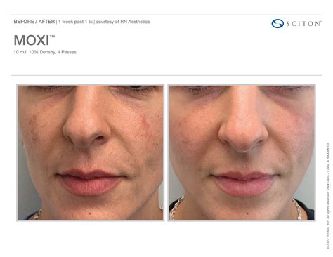 Moxi Laser Fractional Skin Resurfacing Treatment Hanover Ma Alda