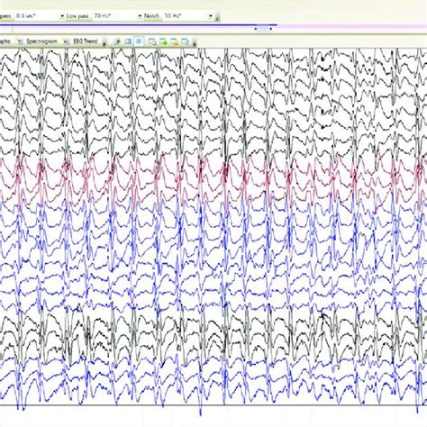 diffusion weighted images showing diffusion restriction in a b