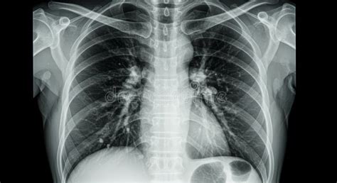 Chest Xray Lung Anatomy And Pathology Medical Showing A Detailed View