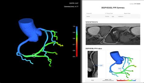 Clinical Validation Of Deepvessel® Ffr Ai Ct Ffr Analysis By Keya