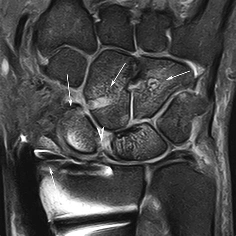 Postoperative Imaging Of The Wrist And Hand Magnetic Resonance