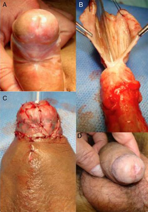 Partial Penectomy And Penile Reconstruction Initial Surgical
