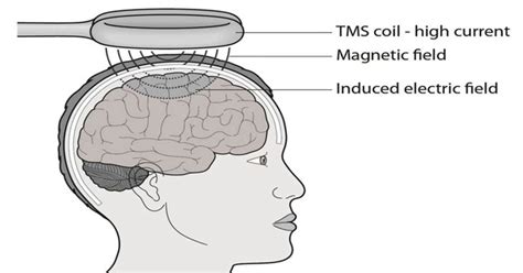 Design For Transcranial Magnetic Stimulation Targets Deeper Brain
